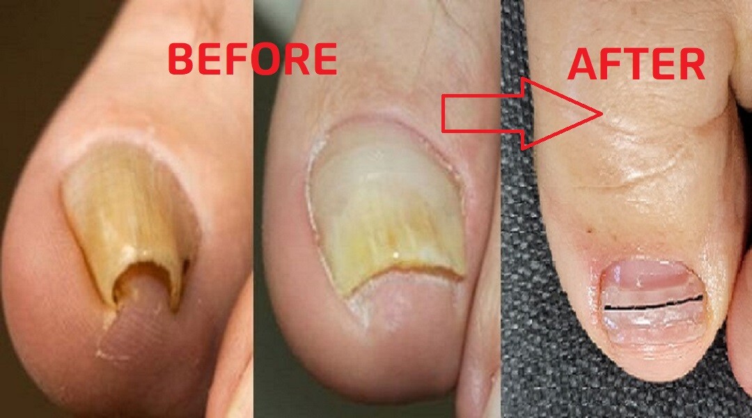 문제성발톱 전문 오일. 케라틴 영양오일 판매합니다.